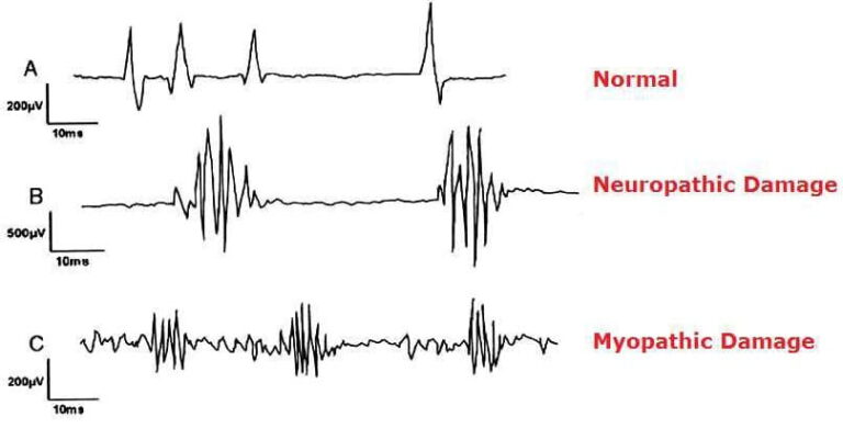 What Is Laryngeal Electromyography (5+5) June 2014 - DNB Mentors